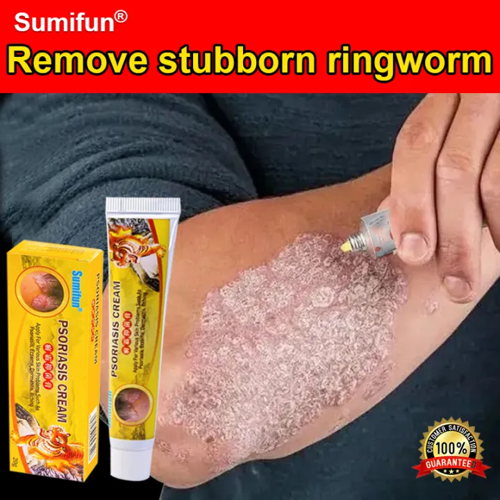 [cod]sumifun Psoriasis Eczema Treatment Cream Antibacterial Cream 20g