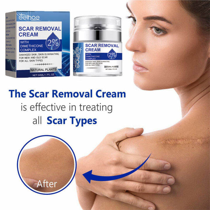 Scar Removal Cream Remover Gel Cream Acne Treatment Skin Care Stretch ...