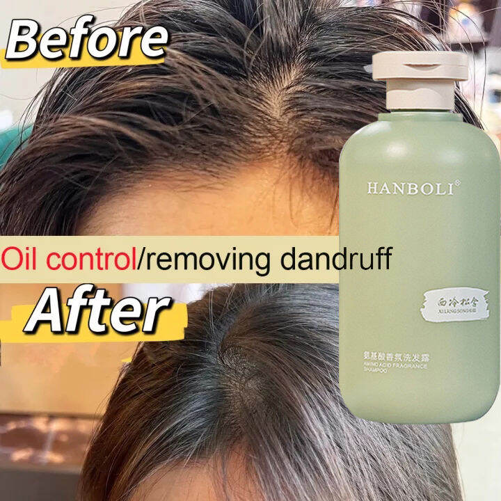 anti-dandruff shampoo set Amino Acid Sea Salt Shampoo Mite Removal ...