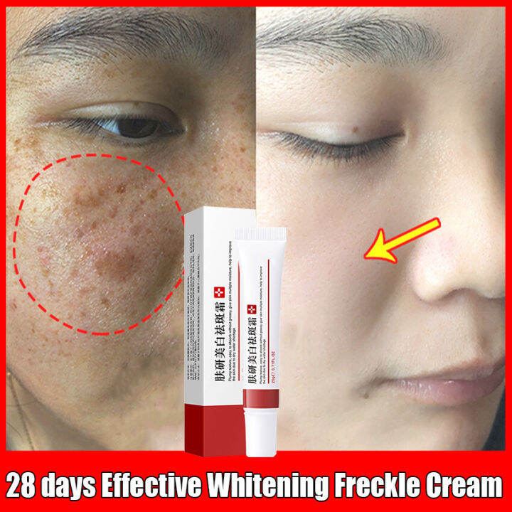 Attraction 20g Effective Freckle Removal Whitening Cream Melasma ...