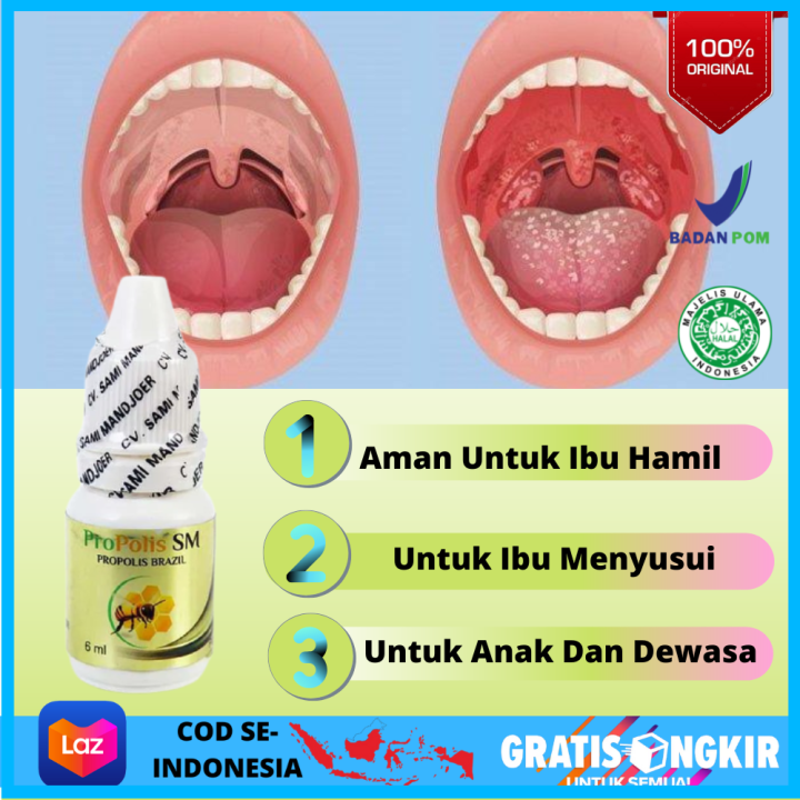 Obat Amandel, Radang Amandel Bengkak, Amandel Bernanah, Nyeri Amandel ...