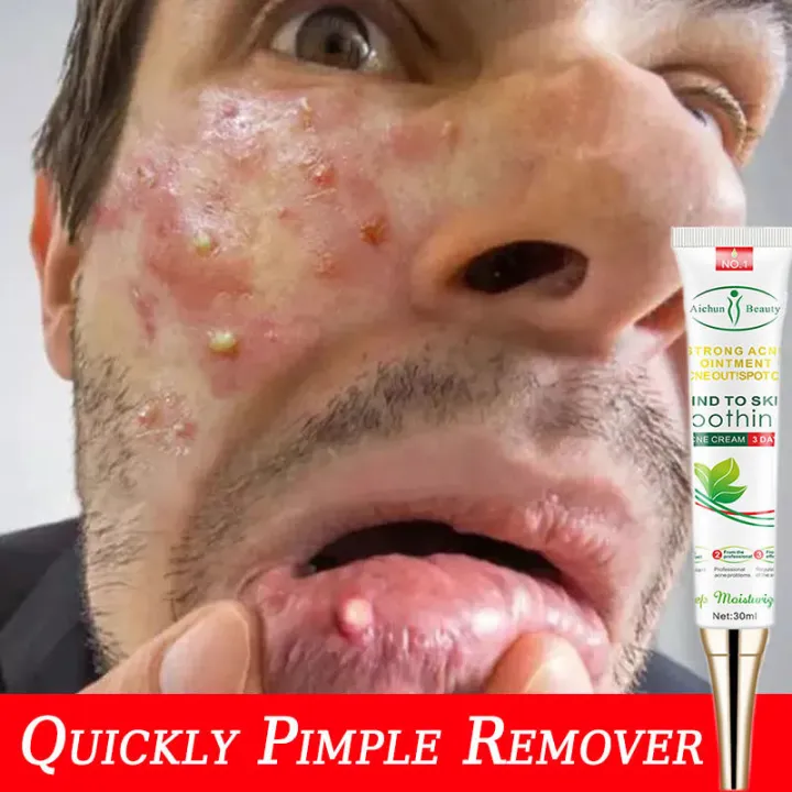 Acne Cream Pimple Eraser Pimple Marks Remover Pimples And Acne Remover ...