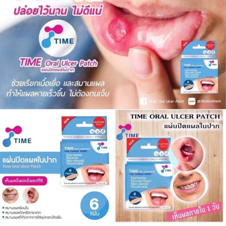 Time oral Ulcer Patch แผ่นแปะแผลร้อนใน แผ่นแปะแผลในช่องปาก | Lazada.co.th