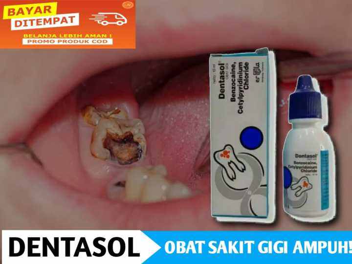 Obat Sakit Gigi Berlubang Dan Gusi Bengkak / Obat Sakit Gusi Bengkak / Obat Sakit Gigi Paling ...