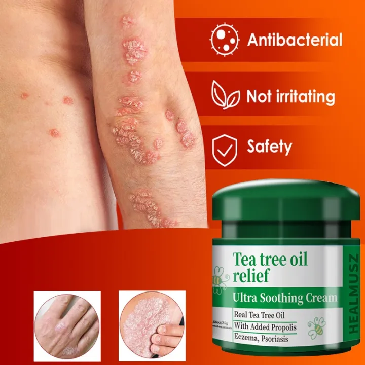 Sell like hot cakes itching cream dermatitis eczema cream itchy skin ...