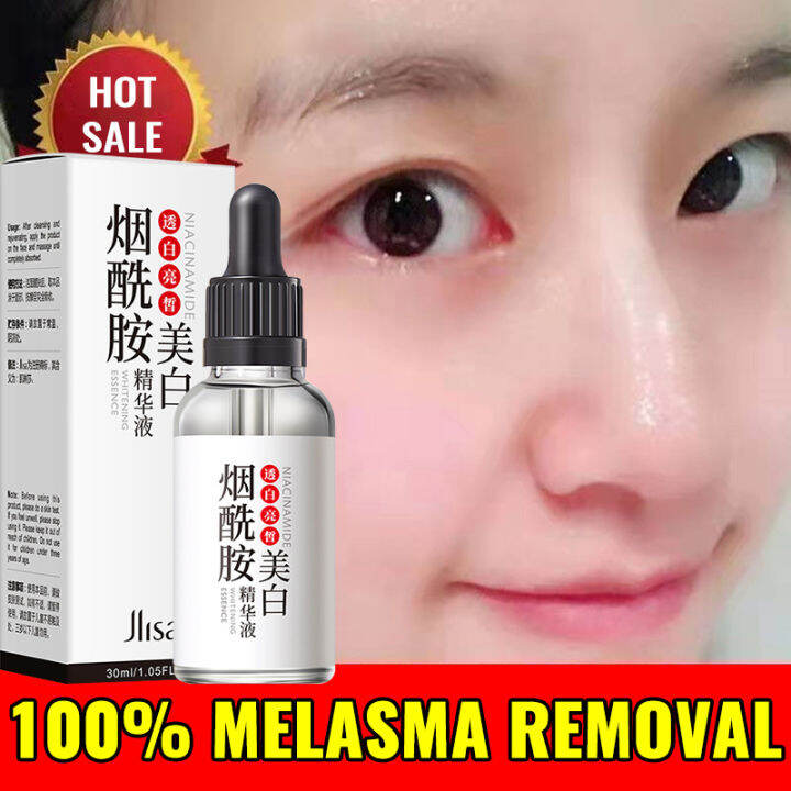 freckle serum Anti-Freckle Essence melasma and pekas remover serum ...