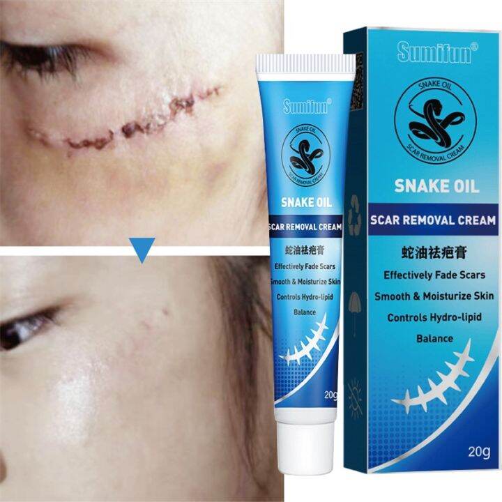 HomeJade Scar Cream Remover Scar Cream Peklat Remover Acne Scar Remover ...
