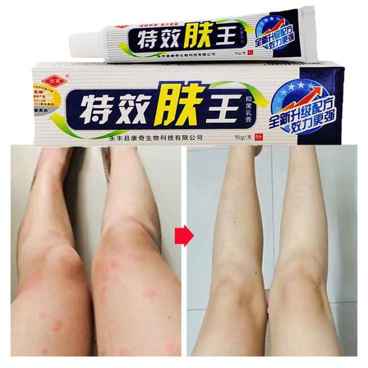Chinas Secret Recipe Psoriasis Antibacterial Cream Body Skin Treatment