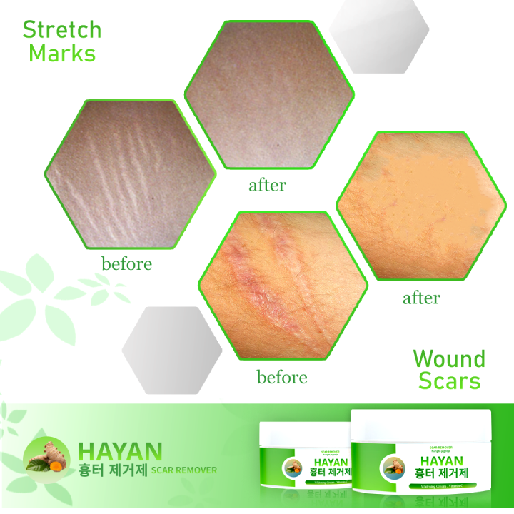 Hayan Korean Essentials Buy 1 Take 1 Best Seller Improved Scar Removing