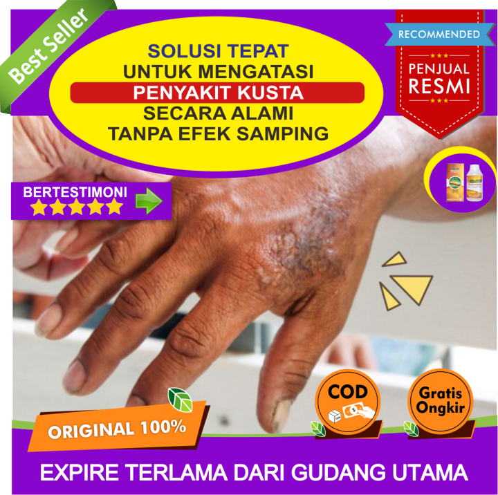 Obat Menyembuhkan Kusta - Obat Salep Untuk Kusta - Obat Ramuan Kusta ...