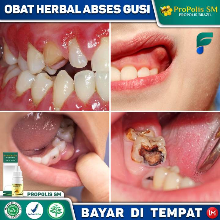 Propolis SM Brazil Abses Gusi - Obat Gusi Nyeri, Gusi Bernanah, Gusi ...