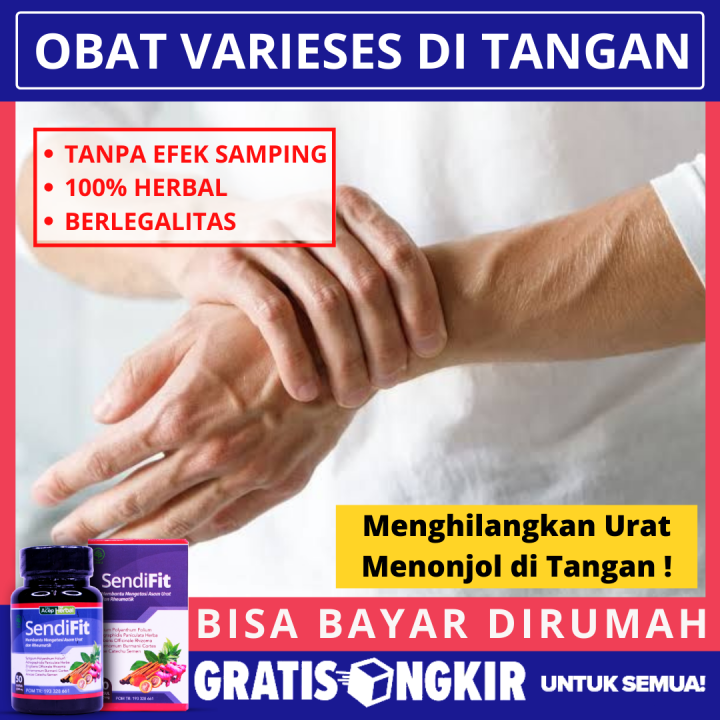 Obat Urat Menonjol di Tangan - Varises di Tangan dan Kaki - Obat ...