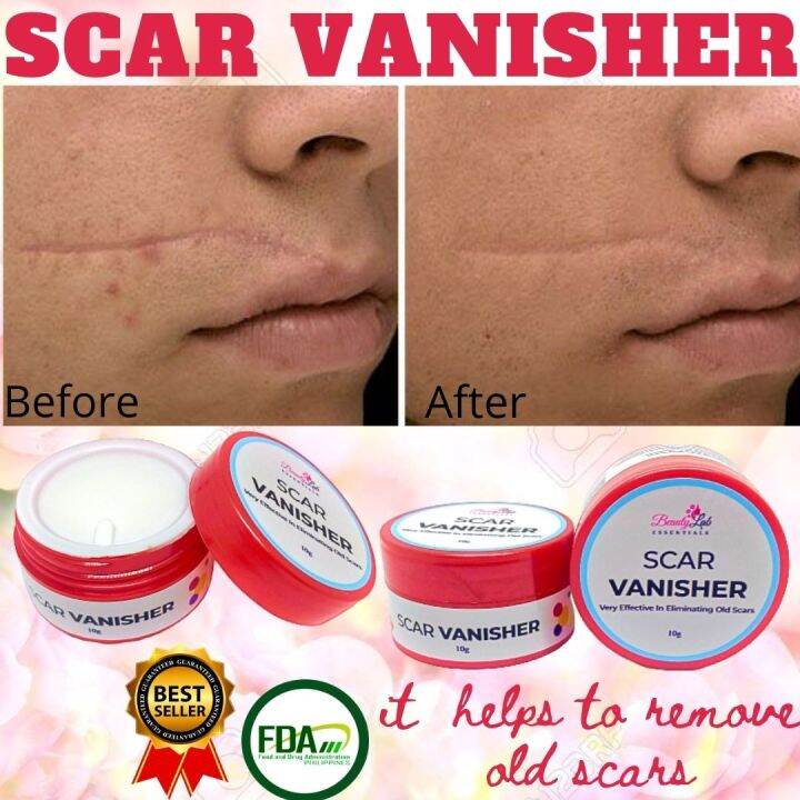 SCAR VANISHER BEAUTY LAB ESSENTIALS SCAR VANISHER 10g for old scar on ...