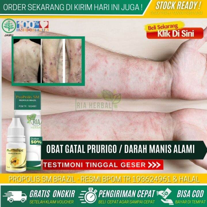 Obat Prurigo, Obat Koreng Gatal, Darah Manis, Bekas Luka Koreng Anak ...