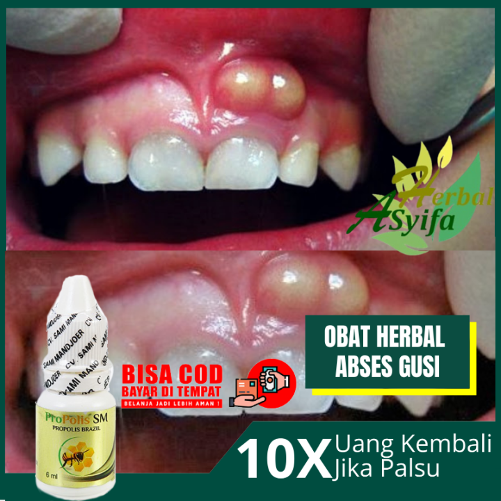 Obat Abses Gigi, Obat Abses Gigi Berulang, Obat Abses Gigi Untuk Anak ...