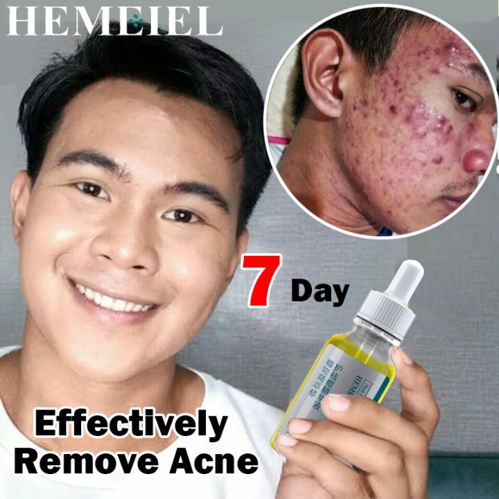 HEMEIEL Pimples Acne Remover Best Seller / Salysilyc Acid / Pang ... HEMEIEL Pimples Acne Remover Best Seller / Salysilyc Acid / Pang ...