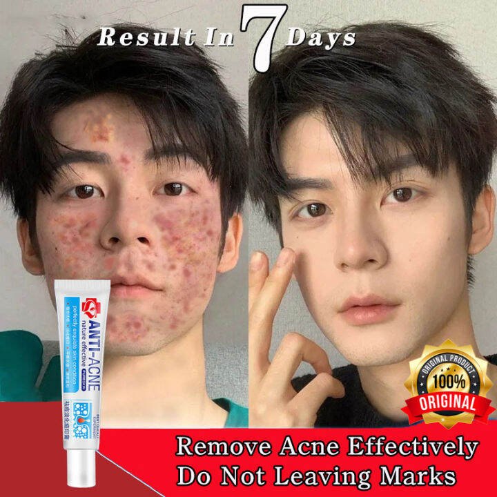 Remove Pimples Quickly Pimple Remover Acne Cream Fades Acne Marks Repairs Acne Pits Facial Scar ...