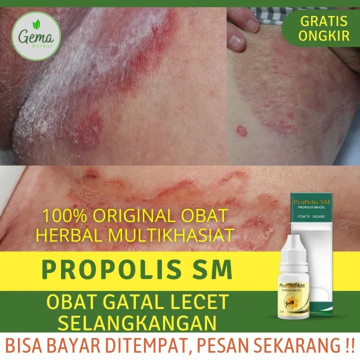 Obat Selangkang Lecet - Obat Selangkangan Gatal Alami, Ruam di ...