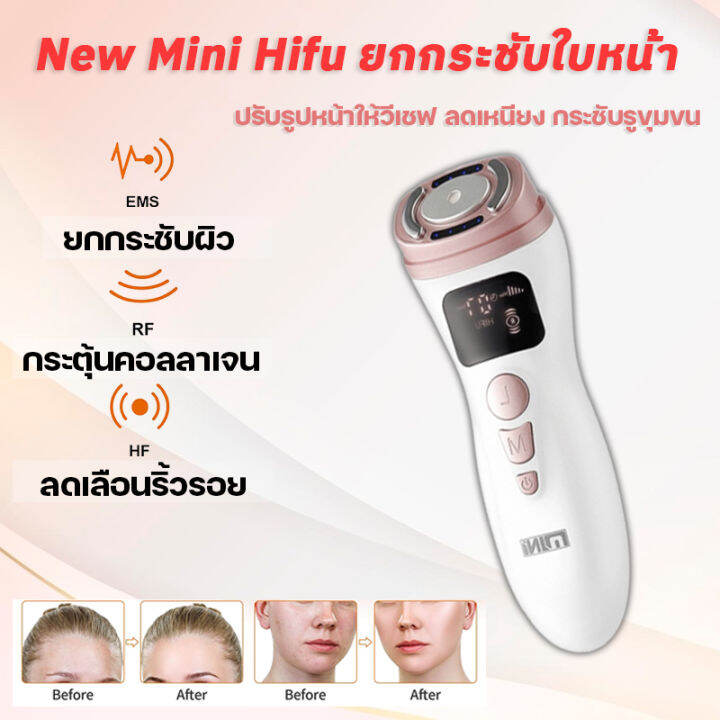 เครื่อง MINI HIFU Gen2 ยกกระชับใบหน้า ฟื้นฟูสภาพผิวหน้า ลดการหย่อนคล้อย ...