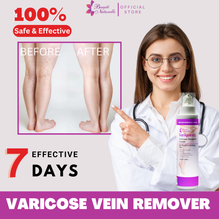 Varicose Veins Remover Effective and Original Anti Varicose Veins ...