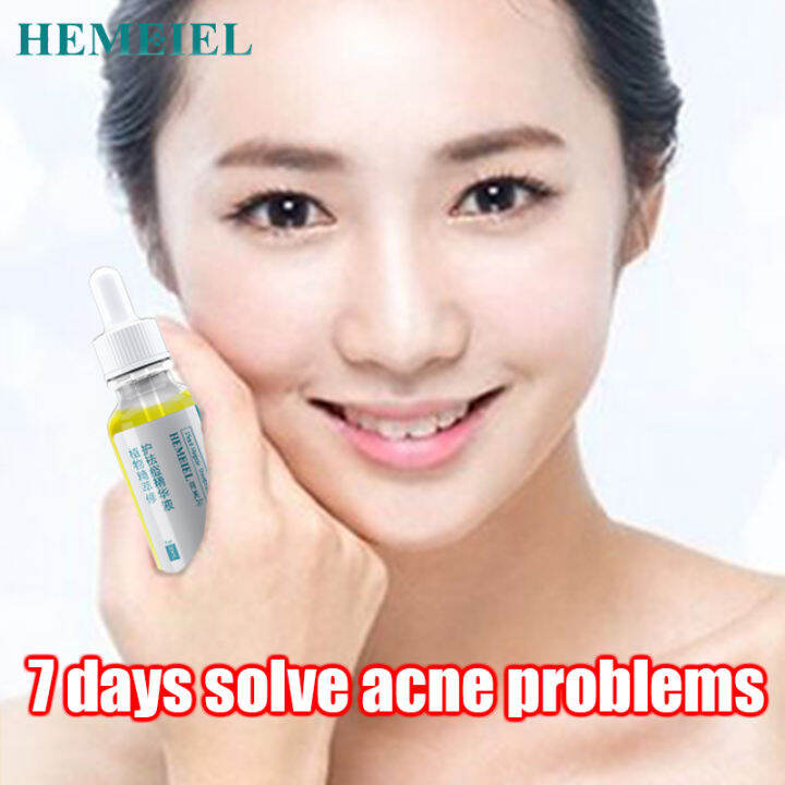 HEMEIEL Pimple Marks Acne Remover | Back Acne Treatment Serum Set ...