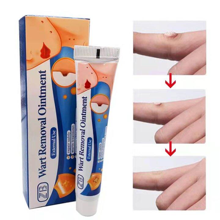 Wart Removal Ointment Treatment Against Moles Ointment Wart Remove ...