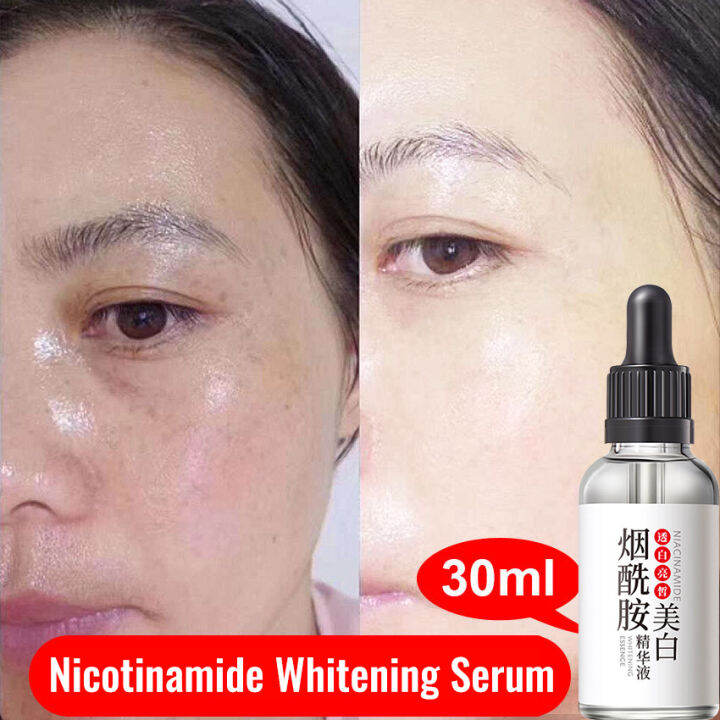 Niacinamide Anti Melasma Serum Melasma Remover From Japan/ The United ...
