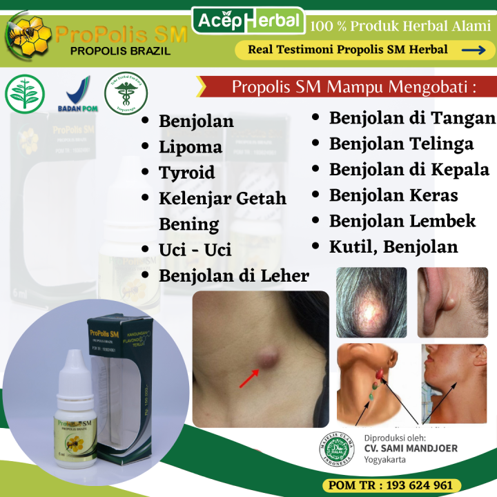 Spesialis Obat Penghancur Lipoma, Propolis SM - kutil, Kapalan ...