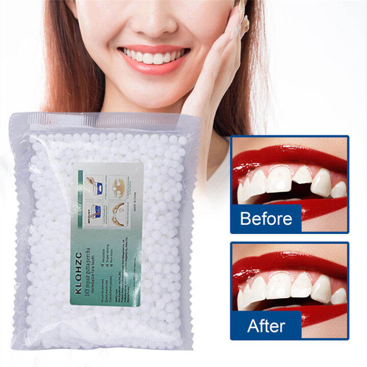 【Fast filling】DIY Tooth Repair Kit Temporary Tooth Repair kit ...