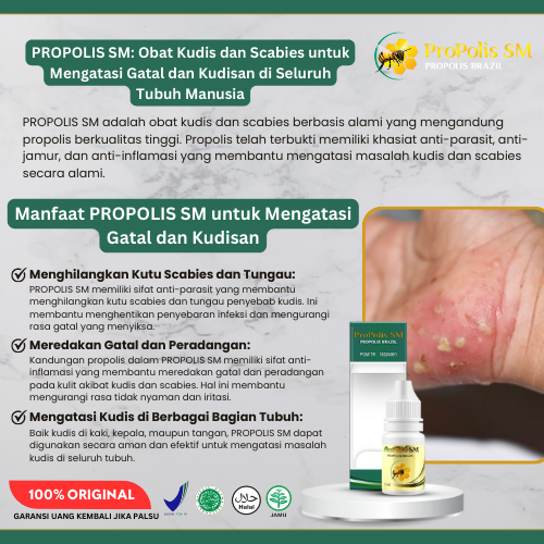Obat Kudis & Scabies, Obat Kudis di Kaki, Kudis di Kepala, Kudis di ...