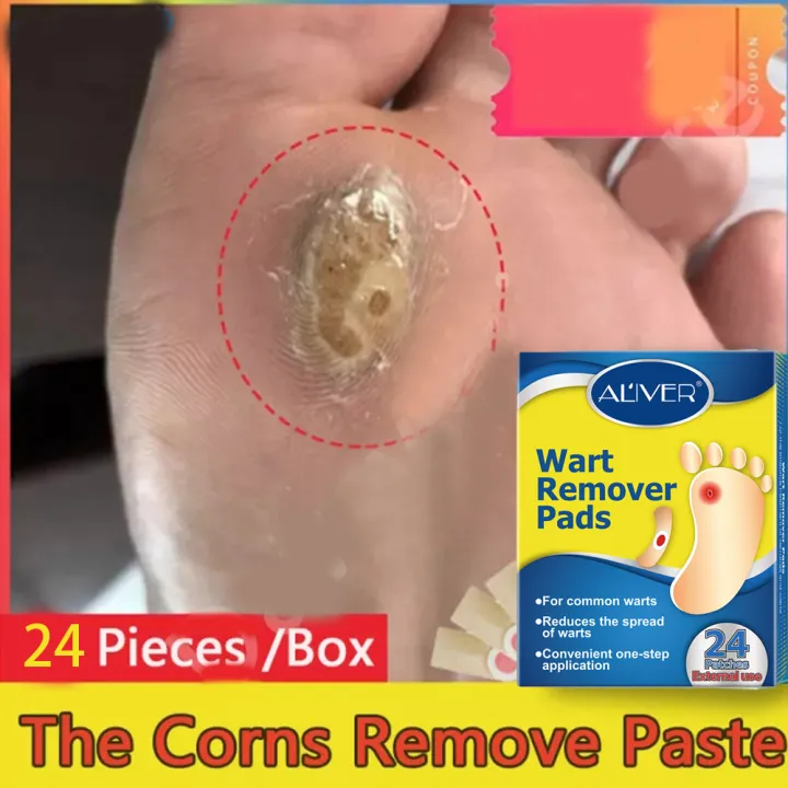 Local delivery Warts Removal Patch Remover Feet Callus Remove Soften ...