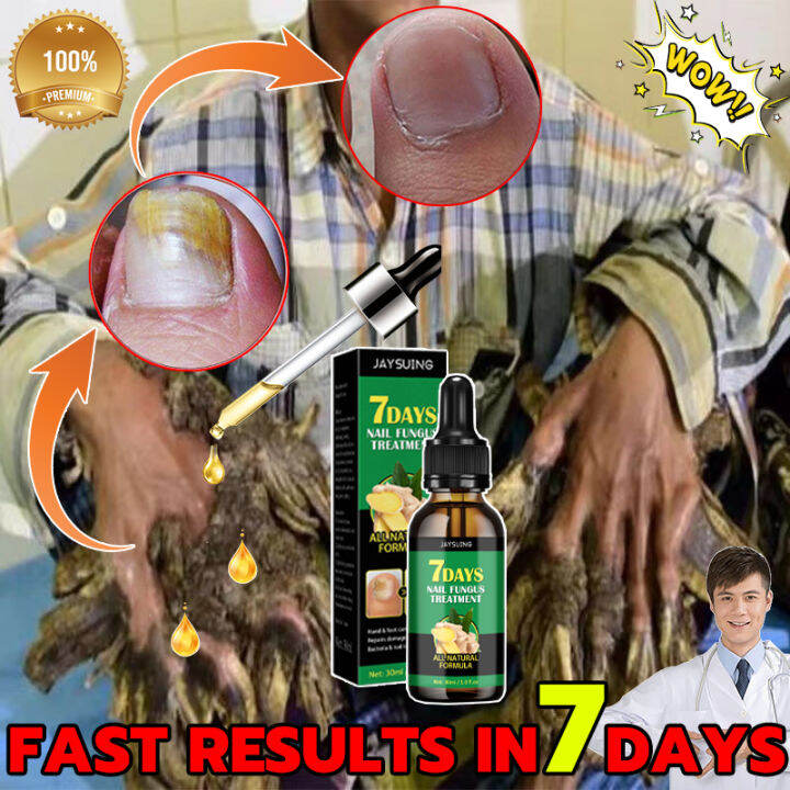 Nail Repair Essence Serum Fungal Nail Treatment Anti Fungal Nail Solution Hand Foot Skin Care ...