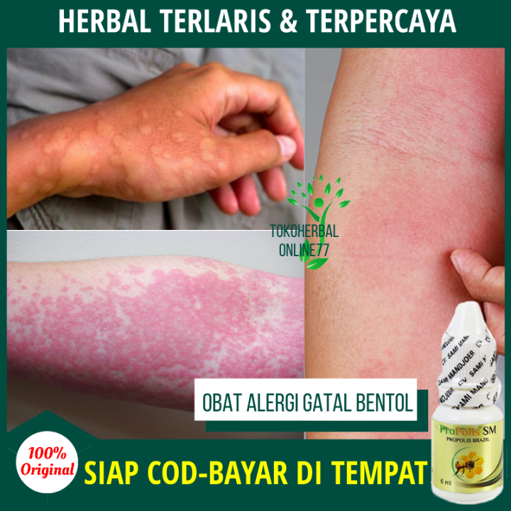 Obat Alergi Kulit, Gatal Bentol, Biduran, Kaligata, Urtikaria, Alergi ...