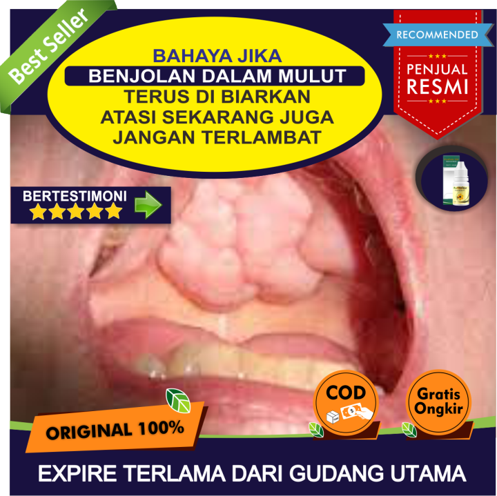 Obat Oles Buat Benjolan Mulut, Obat Ngilangin Benjolan Mulut, Obat ...