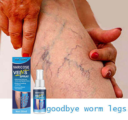 Varicose Veins treatment Spray Earthworm leg Vessel Bulges Removal ...