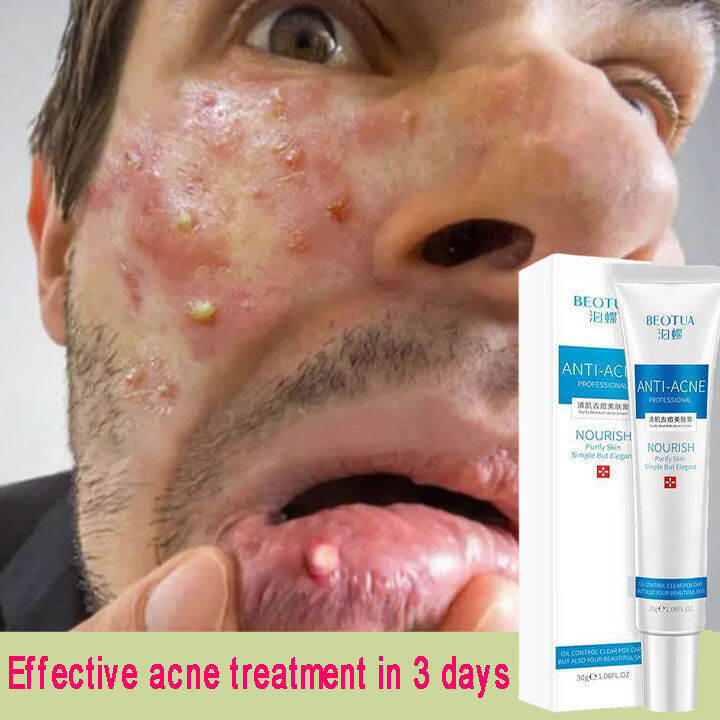 BEOTUA Acne Cream, Acne Repair, Damage Brightening, Oil Control, Shrink ...