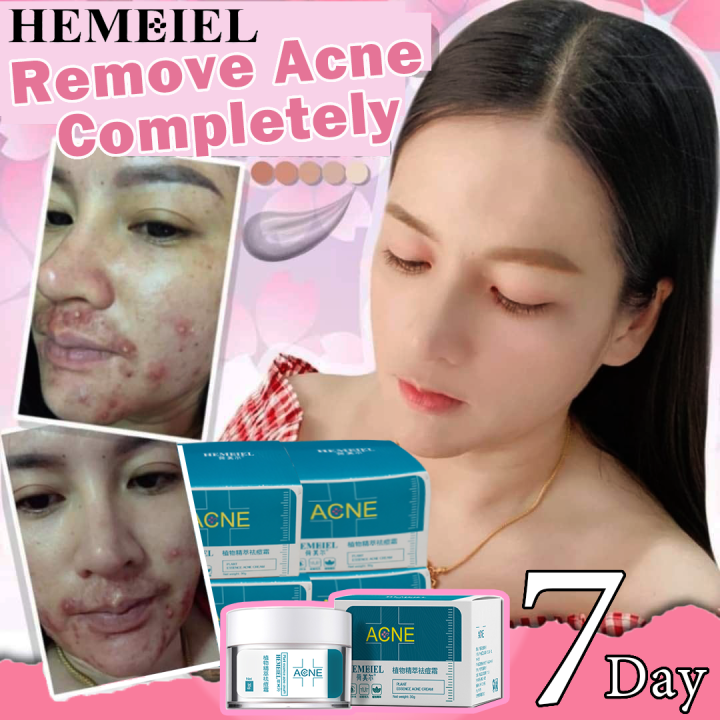 HEMEIEL Pimple Marks Remover/Acne Treatment Set/Gamot sa Tagyawat sa ...