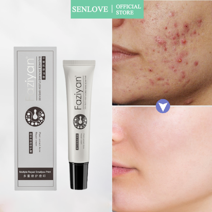SENLOVE Effective Remove Pimples Quickly Pimple Remover Acne Cream Scar ...