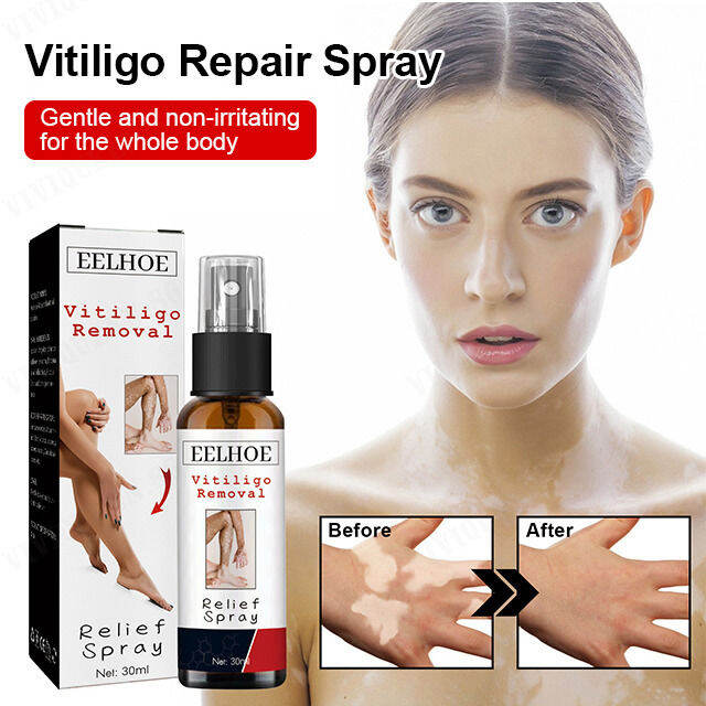 vivigo Vitiligo repair spray | Lazada PH