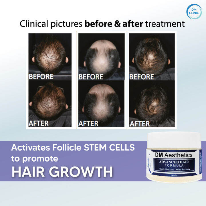 DM Aesthetics ADVANCED HAIR FORMULA(40g) Stimulate Hair Growth + Anti ...
