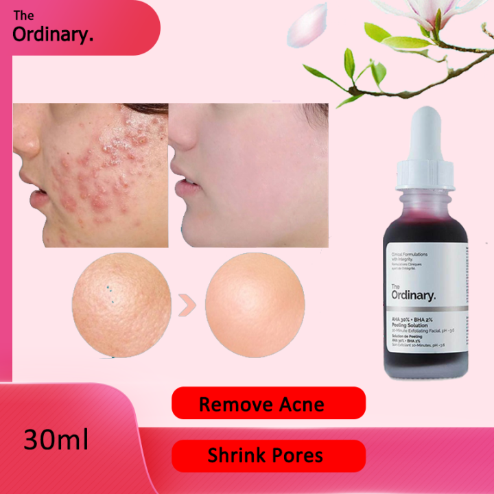 The Ordinary AHA 30%+BHA 2% Peeling Solution Serum Facial Mask Serum ...