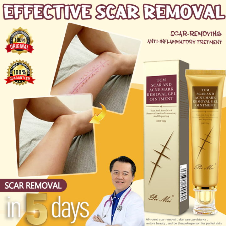 fix scar removal original scars remover for old scars scar gel by doc willie ong scar remover ...