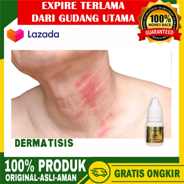Obat dermatitis, untuk dermatitis, kulit dermatitis, gatal dermatitis ...