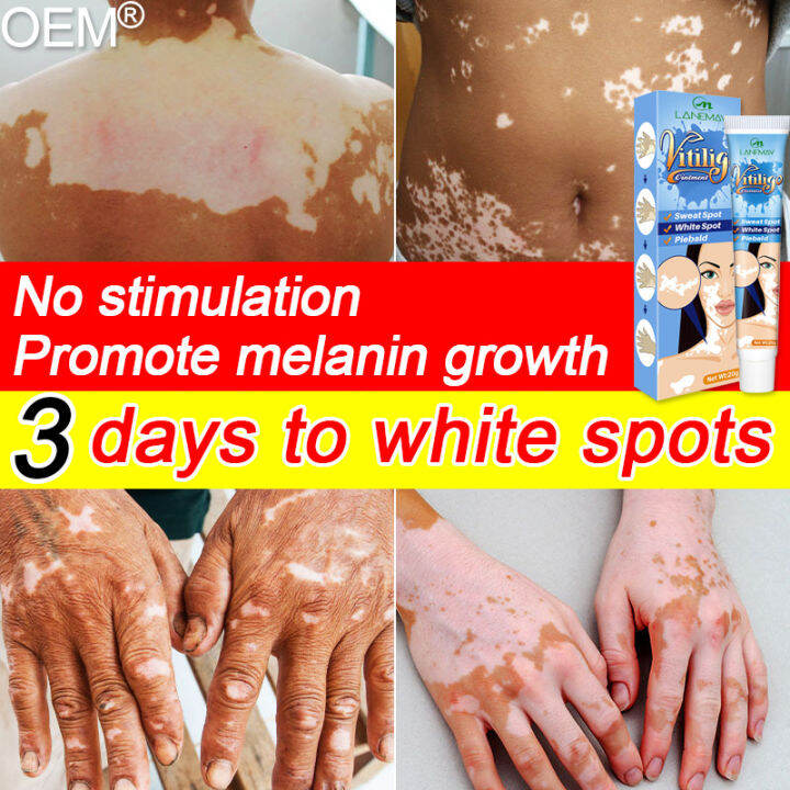 Effective in 3 days OEM atoderma cream vitiligo treatment cream Whole ...