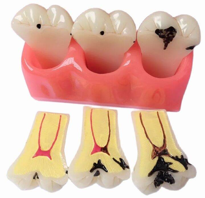 Dental Teeth Model Decayed Model Caries Disease Tooth Model ...