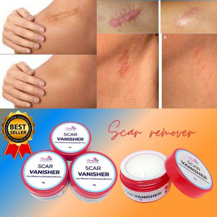 BEAUTY LAB ESSENTIALS SCAR VANISHER 10g Scar Removal Cream Acne Scar ...