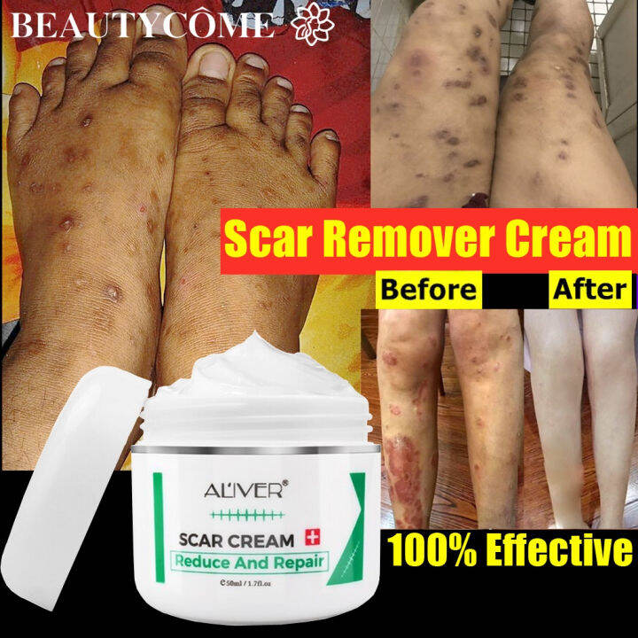 ♜Aliver Scar Removal Cream Peklat Remover Body Repairing Scars Stretch ...