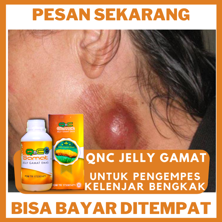 Solusi Obat Kelenjar Getah Bening / Obat Kelenjar Getah Bening ...