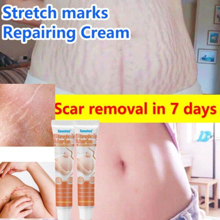 Original Stretch Marks & Scars Remover Cream scar remover for old scar ...