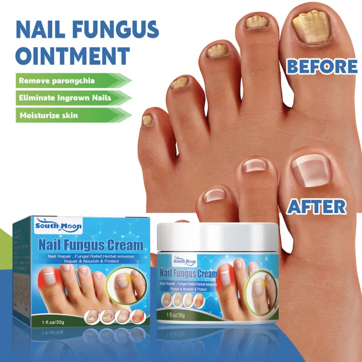 Toenail Fungus Care, Fast-Acting Nail Care Paste For Fungus Under ...